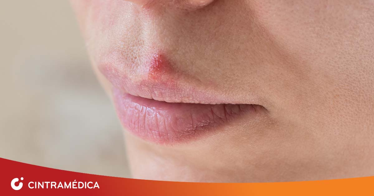 Cintramédica | Herpes Labial: causas, sintomas e tratamento